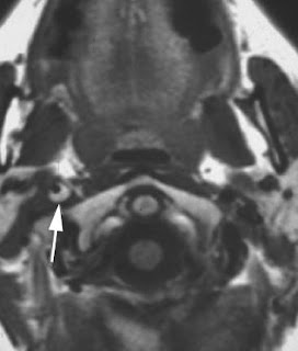 ENTORNO MÉDICO: Sindrome de Horner