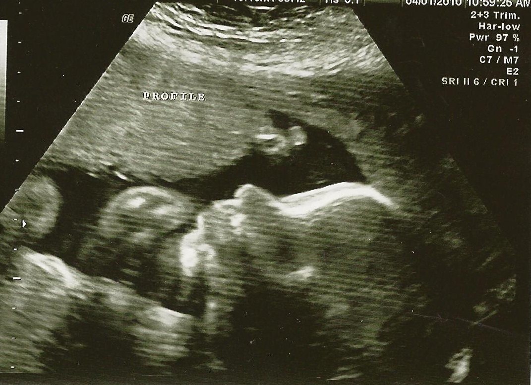 Seeking Sunshine: 30 week ultrasound