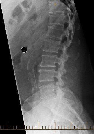 RR234, Rollyview, Alberta, Canada: Lower back X-ray