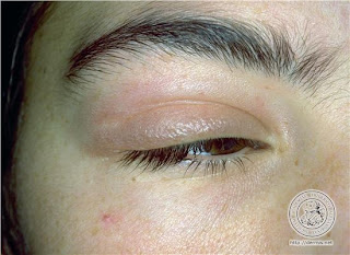 Edema de Quincke, Edema angioneurótico