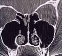 CT/MRI Pathologies: Chronic Sinusitis