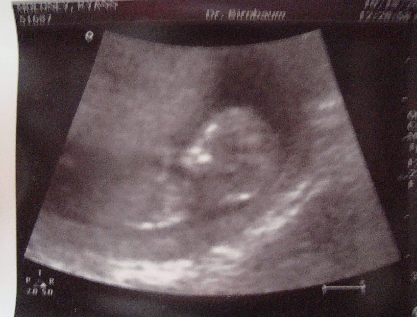 Journey of "The Bump": 12 weeks