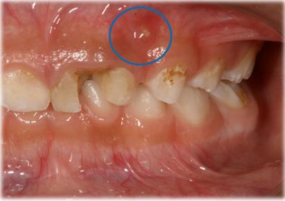 Alteraciones Bucales 3302: Absceso Periapical y Periodontal