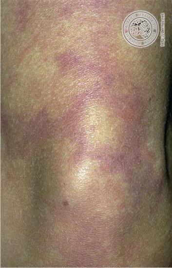 VL - Vida e Luta: Livedo Reticular