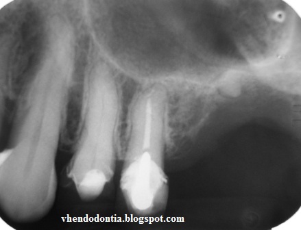 VH Endodontia: Calcificação do canal radicular