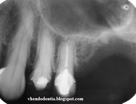 VH Endodontia: Calcificação do canal radicular