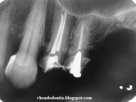 VH Endodontia: Calcificação do canal radicular