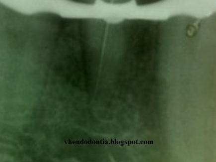 VH Endodontics: Radiographic Apex X Anatomy Apex