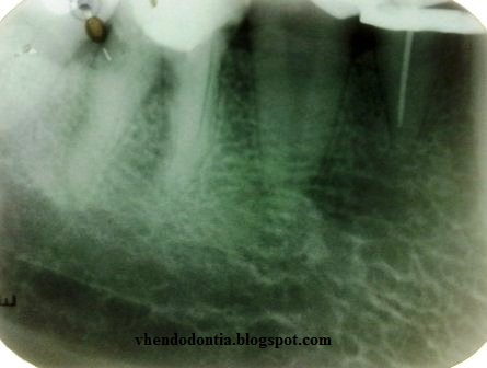 VH Endodontics: Radiographic Apex X Anatomy Apex