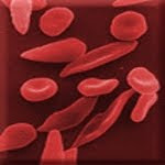 la drépanocytose: Introduction : Qu'est-ce que la drépanocytose