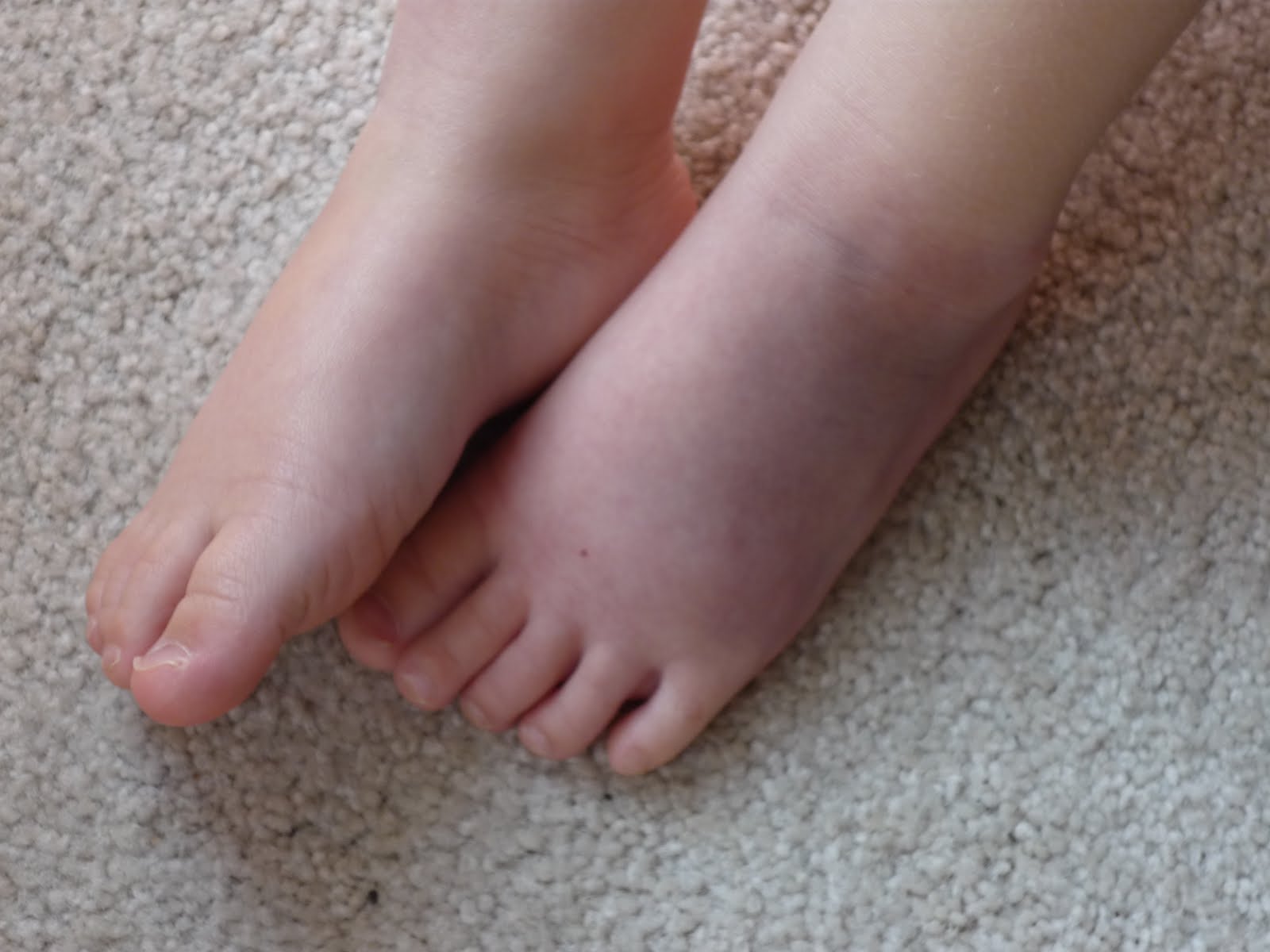 Gibb Spot: Skeeter Syndrome