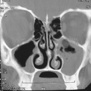 CT/MRI pathology blog: Chronic Sinusitis