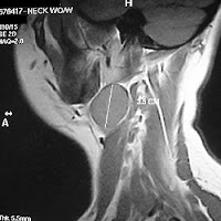 CT/MRI pathology blog: Brachial Cleft Cyst