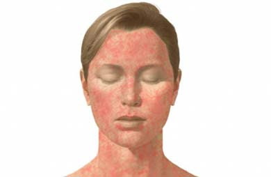 Viriasis exantemáticas