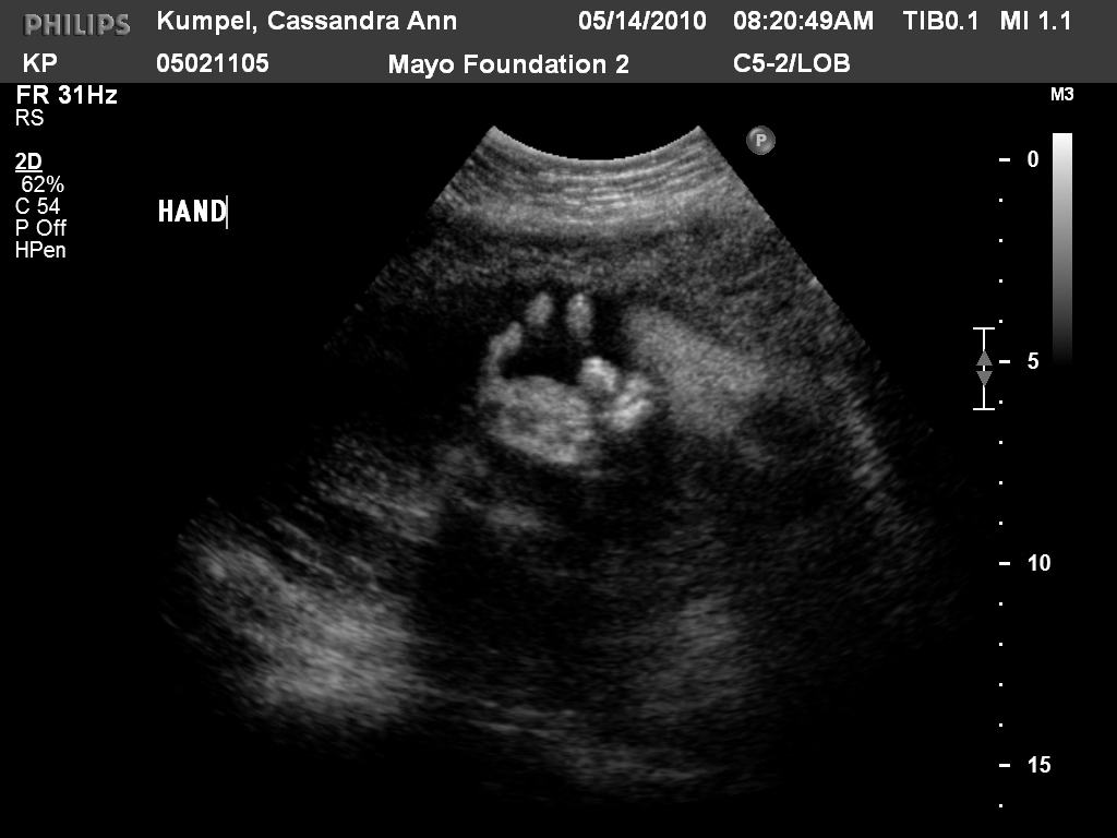 Kumpel Family: 36 week ultrasound