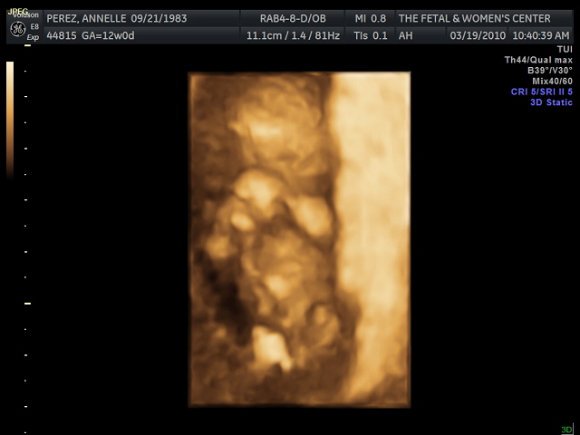I'm going to be a Mommy!: 13 week Ultrasound Pictures