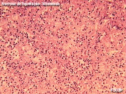 Patologia - Fisioterapia: Necrose