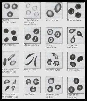 HoLa: ALTERACIONES MORFOLÓGICAS DE LOS ERITROCITOS
