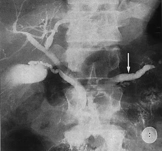 Técnicas Radiológicas y Avances: CPRE