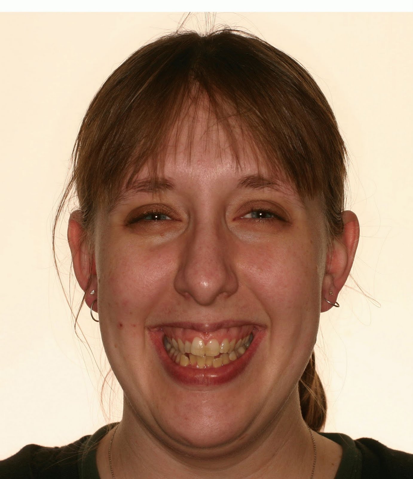 steph's jaw surgery blog: Anniversary