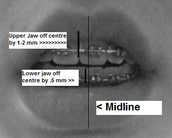 Thrill of the Perfect Grill - A Braces & Jaw Surgery Diary: Pre ...