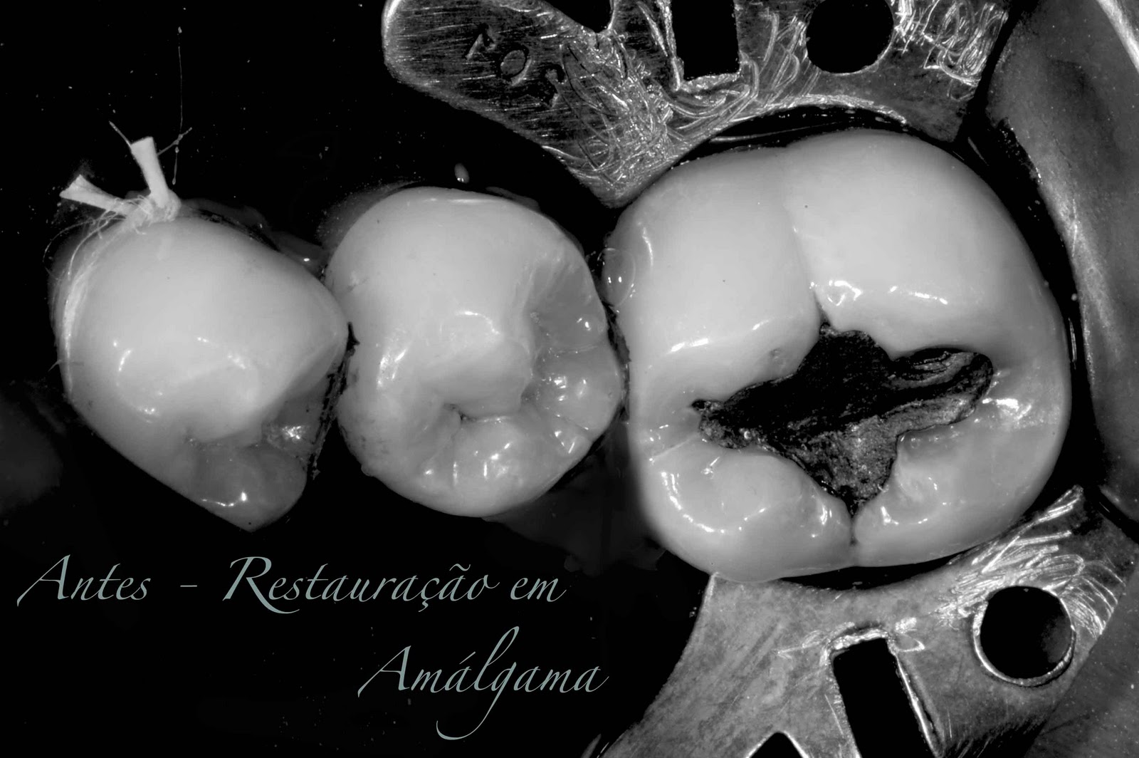 M. Vestphal - Odontologia Estética: Restauração em Resina Composta - 4 ...