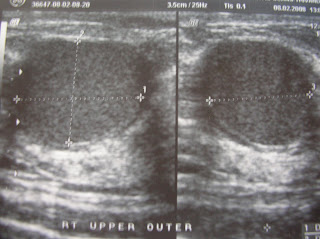 METROSCANS: Galactocele