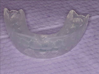 aryabrahmanta: ORTHODONTIC RETAINER