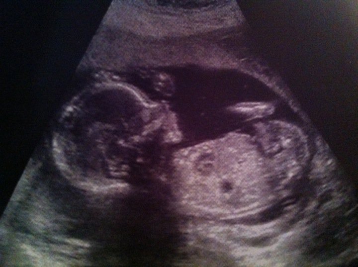 Kurdishflower: Föreliggande moderkaka eller placenta praevia