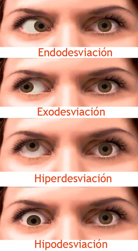 Tecnología Médica - Mención en Oftalmología: Generalidades del Estrabismo