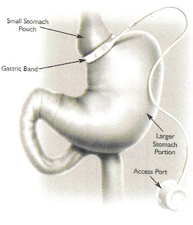 FAT JACK – skinny whinny: The Results of the Bariatric Surgery Seminar