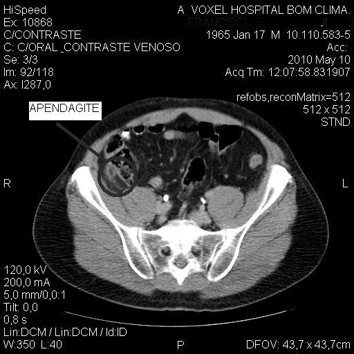 Webimagemradiol: Suspeita de apendagite em cólon direito ao exame ...
