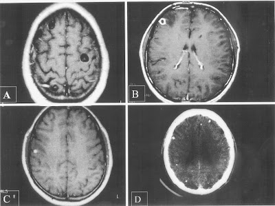 Neurología en Medicina Familiar: CASO CLINICO 3