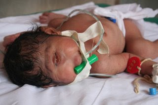 wihah rulez: Cyclopia Syndrome