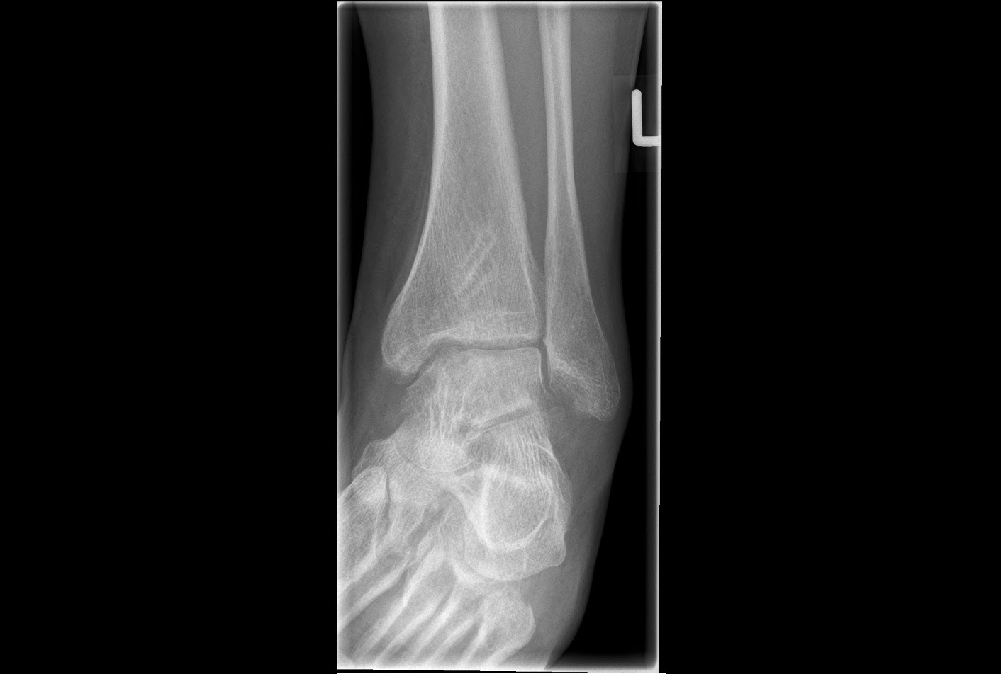 Sprunggelenksarthrose bei Osteochondrosis dissecans beider OSG ...