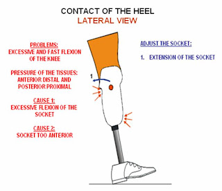 osteo support: TRANS-TIBIAL DYNAMIC ALIGNMENT