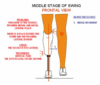 osteo support: TRANS-TIBIAL DYNAMIC ALIGNMENT