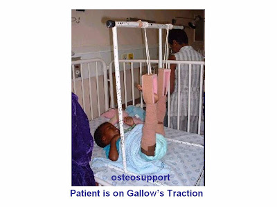 osteo support: Gallow's skin traction aids