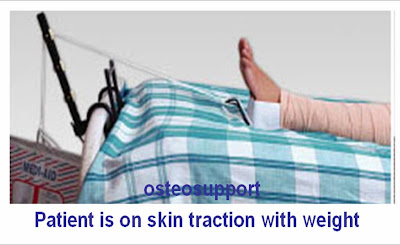 osteo support: Skin traction aids