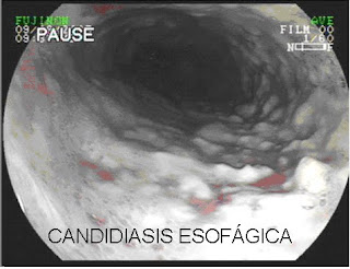 esofagitis infecciosa kd: esofagitis por hongos,bacterias y virus