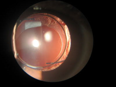 Take Care Of Your Eyes: IOL inside the Eye. Pseudophakos