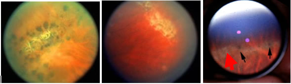 PREVENIR LA CEGUERA: DESGARROS Y AGUJEROS DE RETINA...