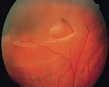 PREVENIR LA CEGUERA: DESGARROS Y AGUJEROS DE RETINA...