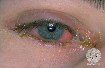 ACRESCER: SÍNDROME DE STEVENS JOHNSON(SSJ)