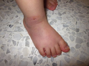 Bubbly Baby and Me: Mosquito Bite. Swollen Feet.