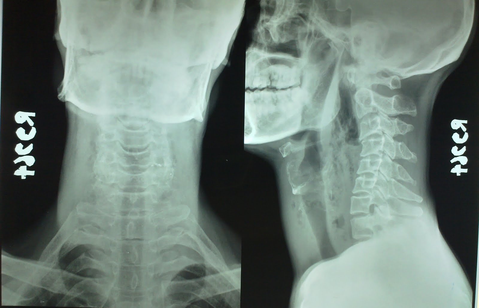 IRRADIATED - Radiology: Retropharyngeal Abscess