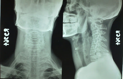 IRRADIATED - Radiology: Retropharyngeal Abscess