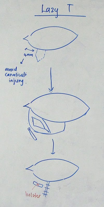 UKM Ophthal Part 2 2010: Ectropion