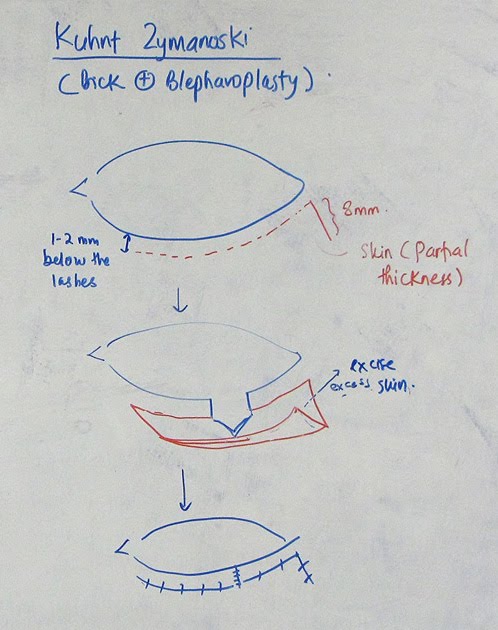 UKM Ophthal Part 2 2010: Ectropion