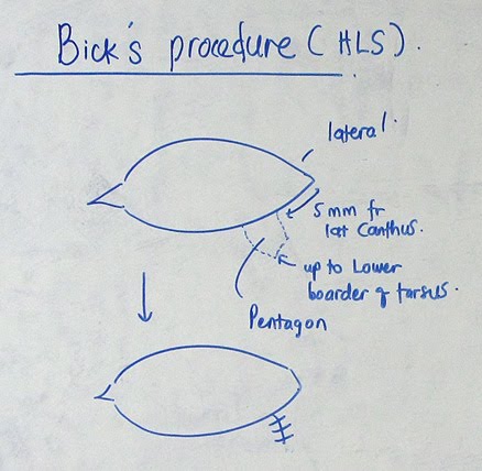 UKM Ophthal Part 2 2010: Ectropion